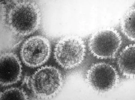 vírus-herpes