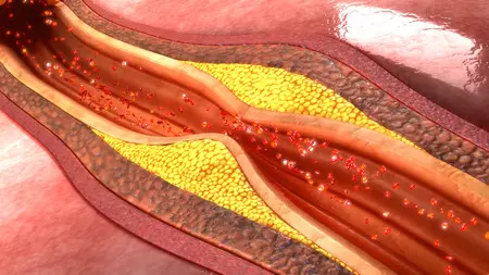 arteriosclerosis