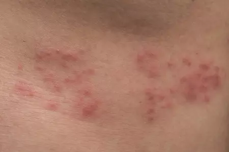 izilonda-herpes-zoster