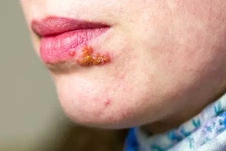 herpes oral