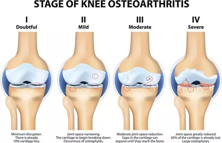 Osteoarthritis