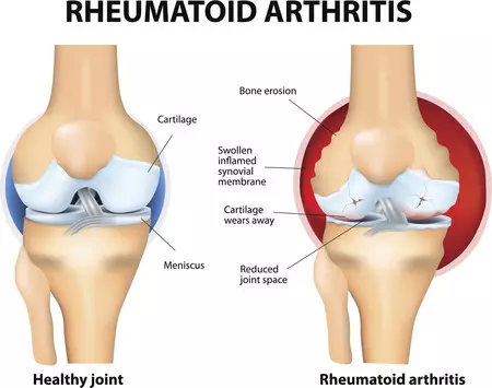 Rheumatoid arthritis