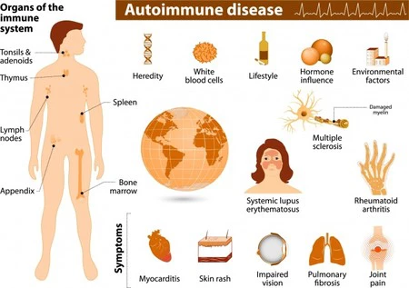 autoimmune كېسەللىكى