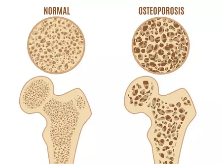 osteoporosis