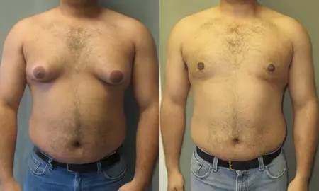 Gynecomastia