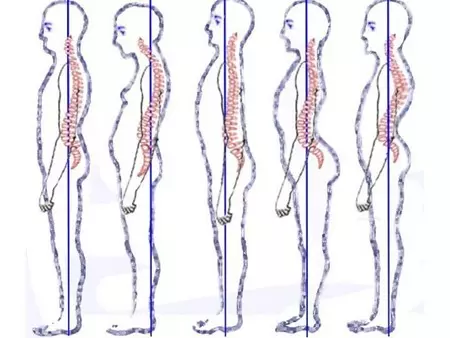 kyphosis