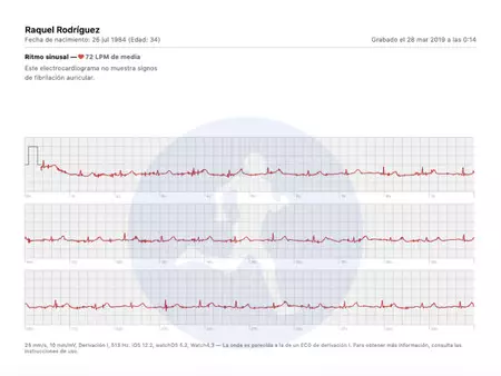 ecg-apple-watch