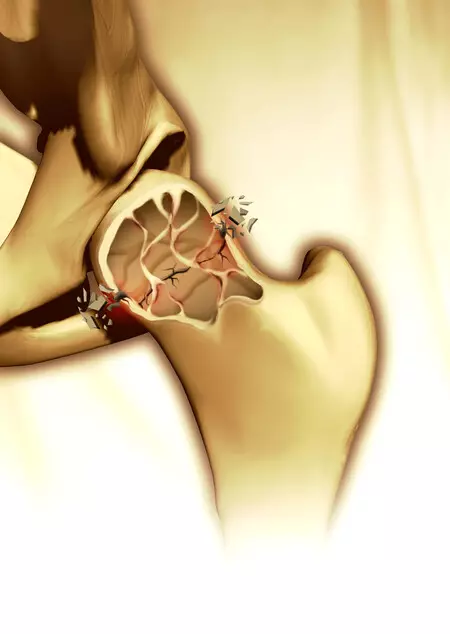 Hezur-haustura Osteoporosia