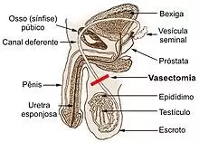 vasektomie