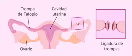 tubal ligation