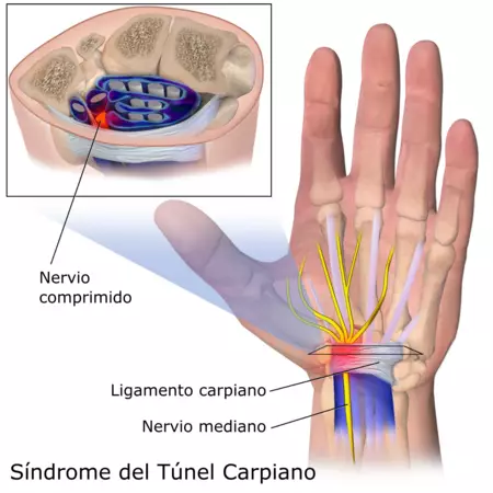 carpal-tunnel-پیشہ ورانہ-بیماری۔