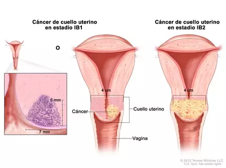cervix-cancer
