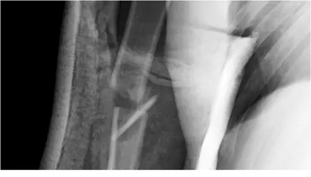 Distal Humerus Fracture