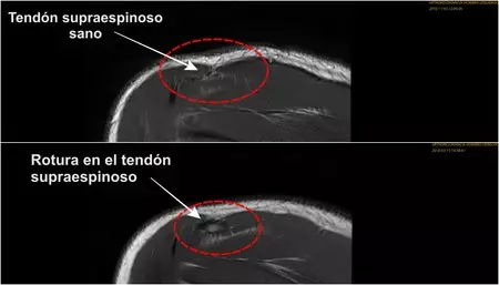 Салыстырмалы Supraspinatus Healthy Broken