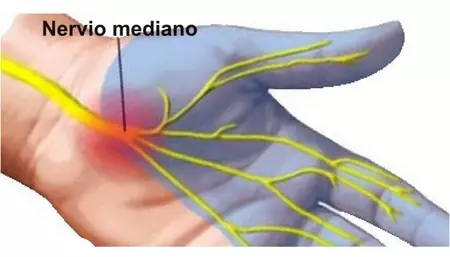 Sindroma e tunelit karpal