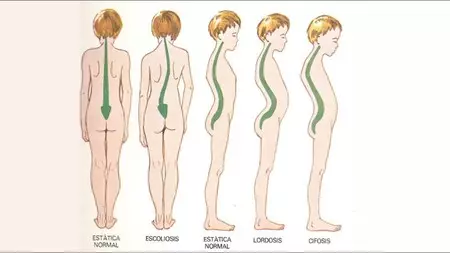 cong vẹo cột sống-kyphosis