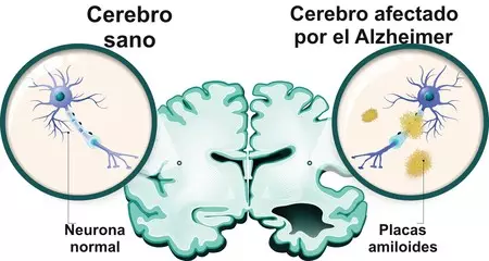 demensia otak