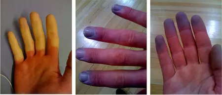 1024px Raynaud Phenomenon