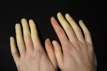 Hội chứng Raynaud 1024px